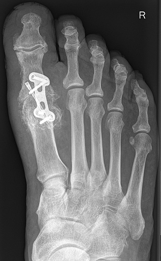 Slijtage grote teen (hallux rigidus) - Rijnland Orthopaedie